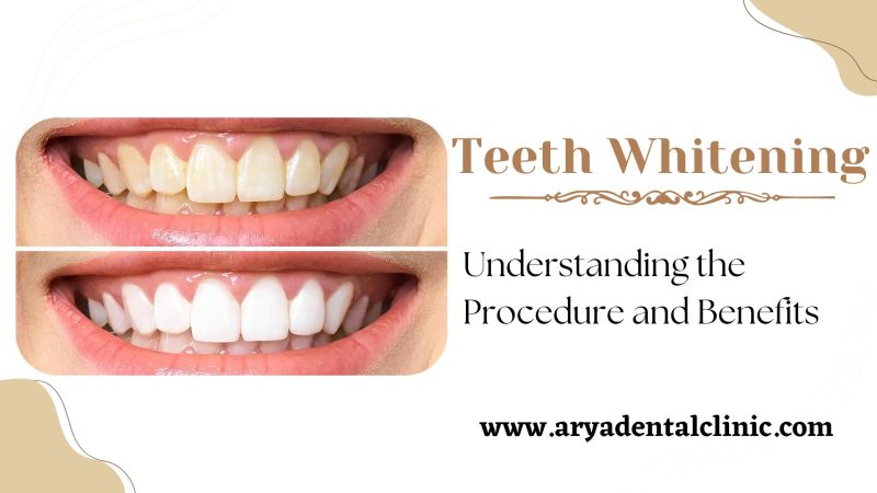 Teeth Whitening: Understanding the Procedure and Benefits – Arya Dental ...