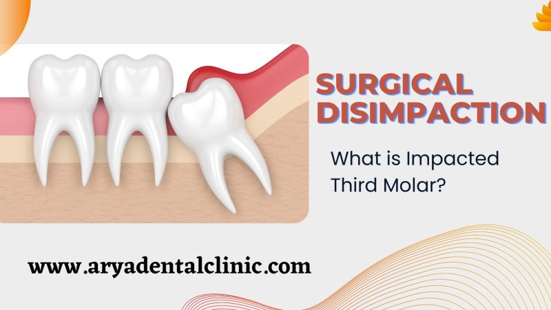 Surgical Disimpaction:- What is Impacted Third Molar? – Arya Dental Clinic
